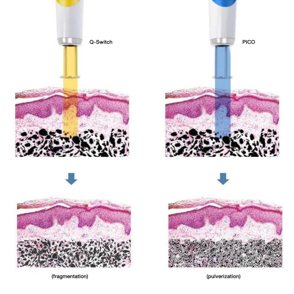 พิโค่เลเซอร์ (Pico Laser) คืออะไร ราคาเท่าไร ช่วยอะไรได้บ้าง