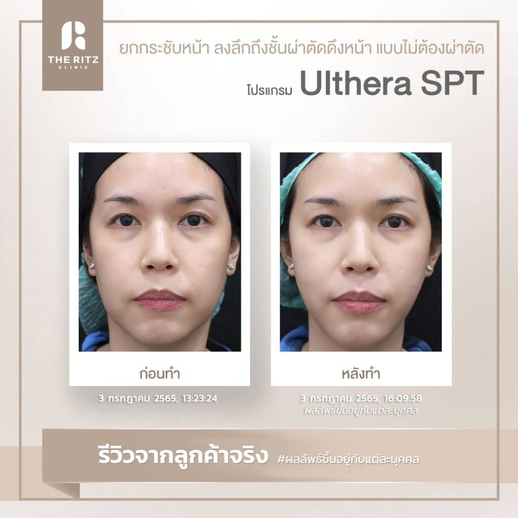 Ulthera SPT คืออะไร ยกกระชับหน้าได้ดีกว่า Ulthera แบบเดิมจริงไหม?