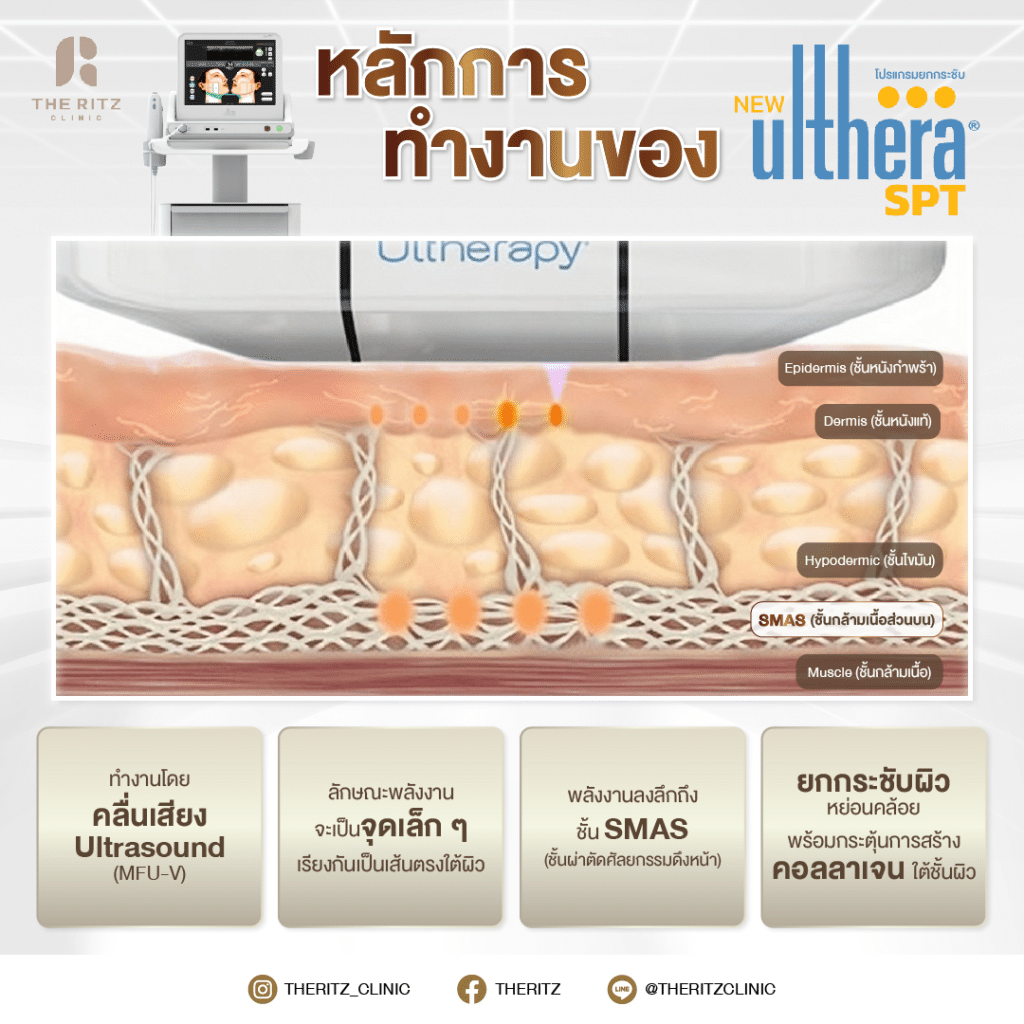 Ulthera (อัลเทอร่า) คืออะไร ยกกระชับผิวได้อย่างไร ราคาเท่าไหร่