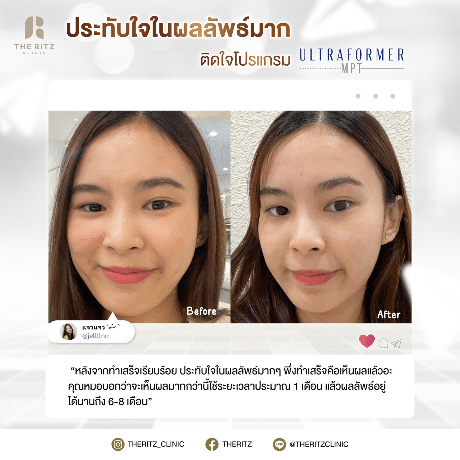 รวมรีวิว Ultraformer MPT สุดปัง ยกกระชับผิว หน้าใส ที่ The Ritz Clinic