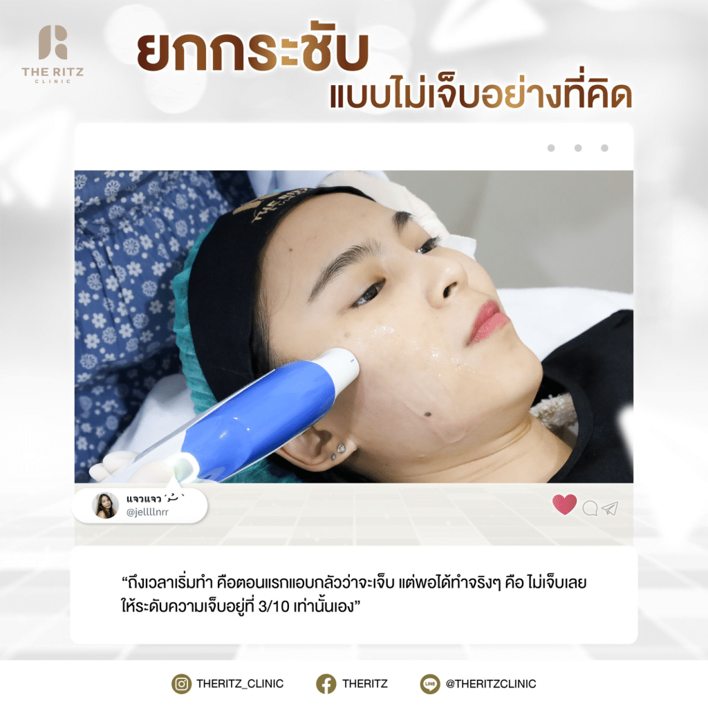 รวมรีวิว Ultraformer MPT สุดปัง ยกกระชับผิว หน้าใส ที่ The Ritz Clinic