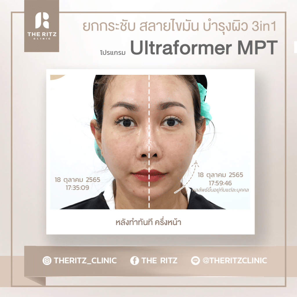 รวมรีวิว Ultraformer MPT สุดปัง ยกกระชับผิว หน้าใส ที่ The Ritz Clinic