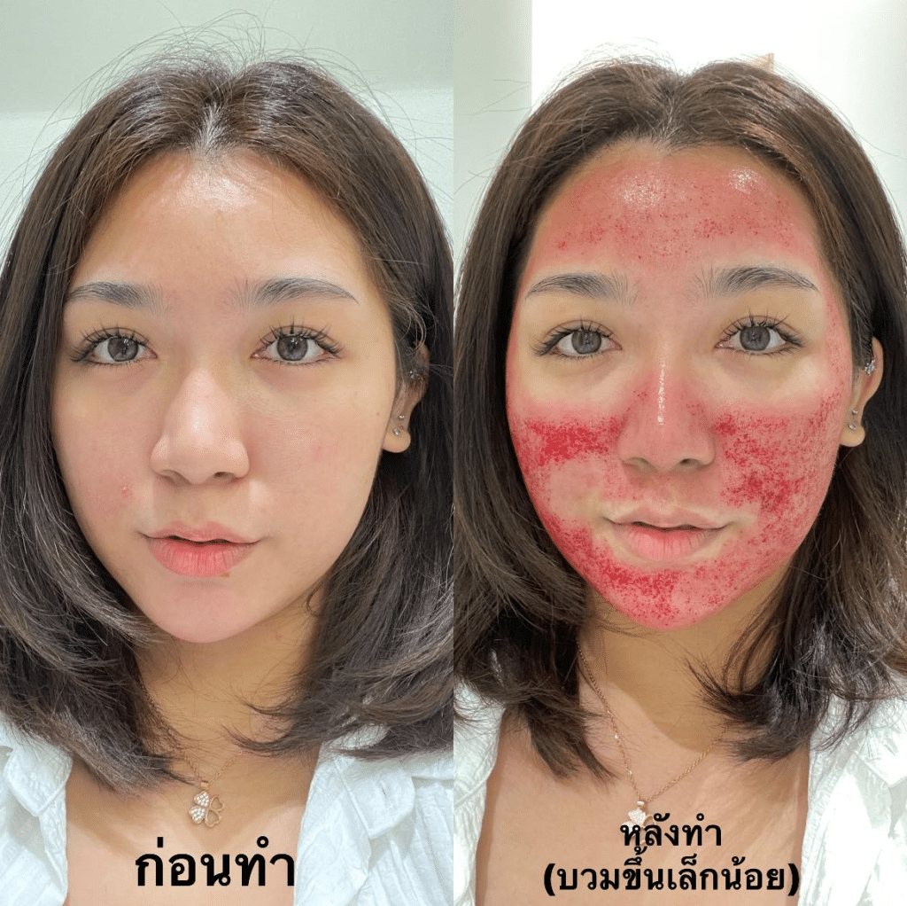 รวมรีวิว Pico Laser รักษาหลุมสิว รอยสิว รอยดำ ที่ THE RITZ CLINIC