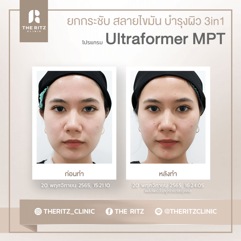 รวมรีวิว Ultraformer MPT สุดปัง ยกกระชับผิว หน้าใส ที่ The Ritz Clinic