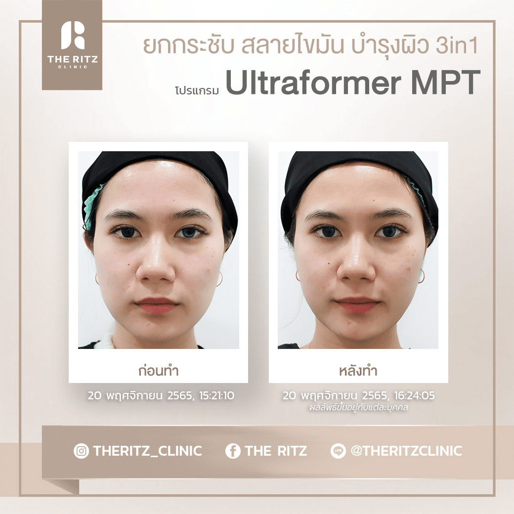 รวมรีวิว Ultraformer MPT สุดปัง ยกกระชับผิว หน้าใส ที่ The Ritz Clinic