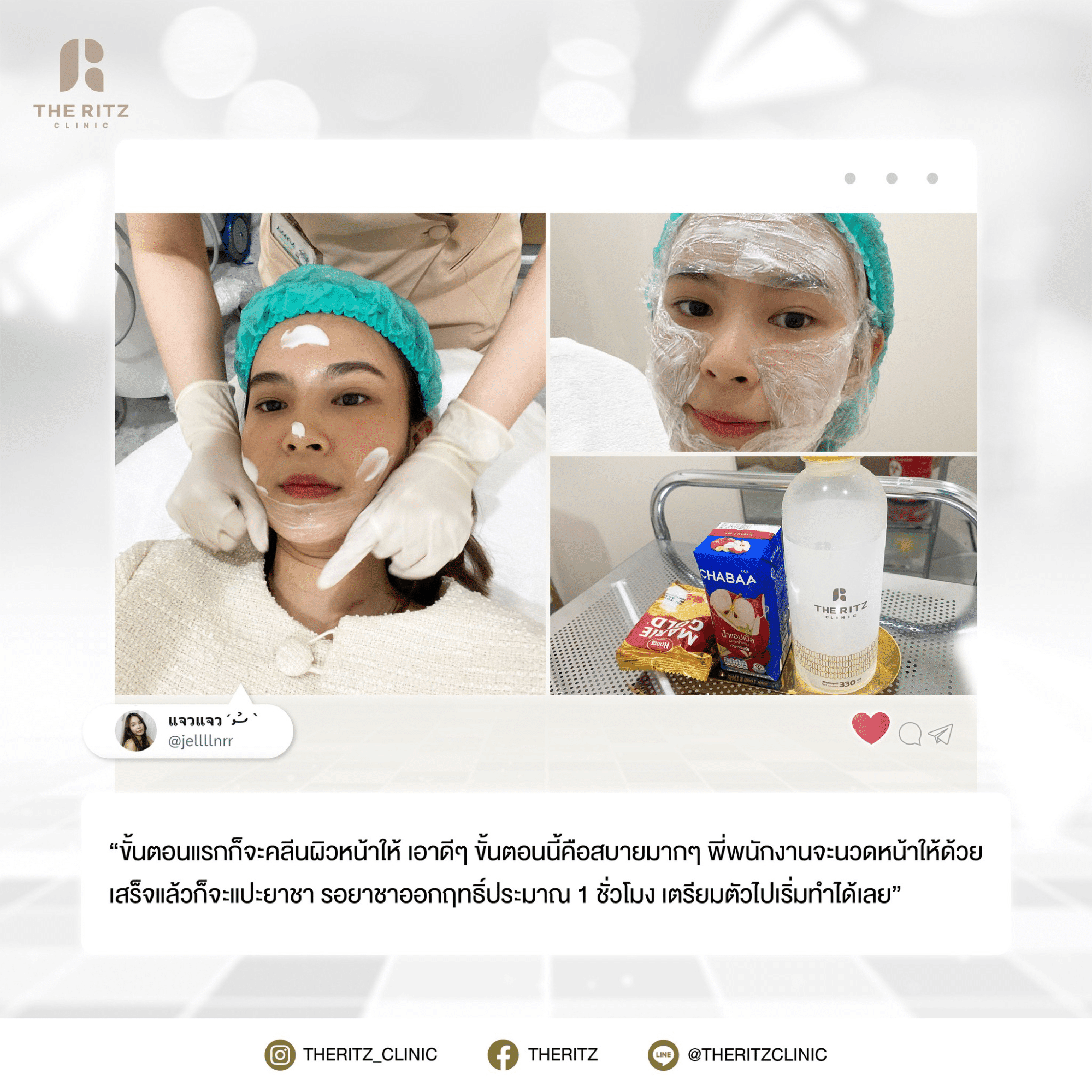 รวมรีวิว Ultraformer MPT สุดปัง ยกกระชับผิว หน้าใส ที่ The Ritz Clinic