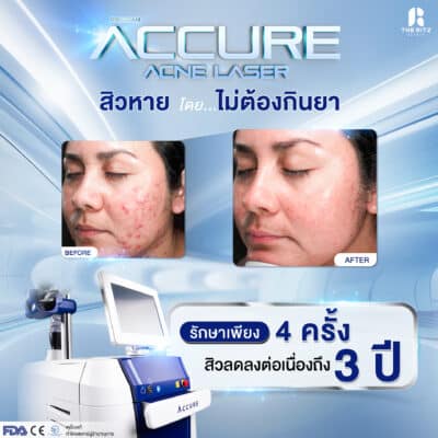Accure Acne Laser - THE RITZ CLINIC เดอะริทซ์ คลินิก