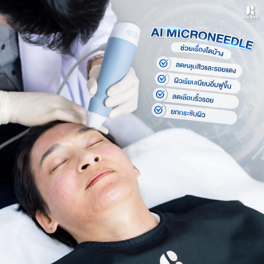 EXION โปรแกรม AI Microneedle RF - THE RITZ CLINIC เดอะริทซ์ คลินิก