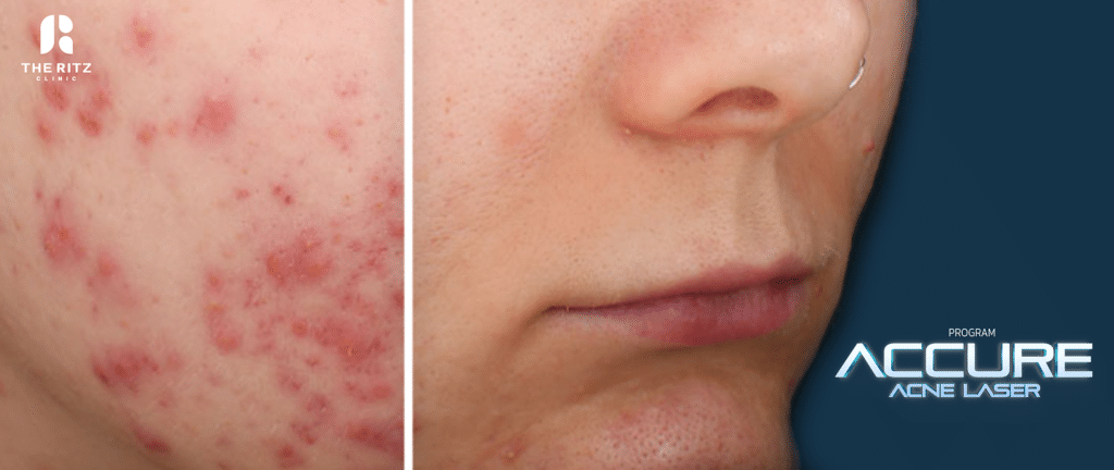 Accure Acne Laser - THE RITZ CLINIC เดอะริทซ์ คลินิก